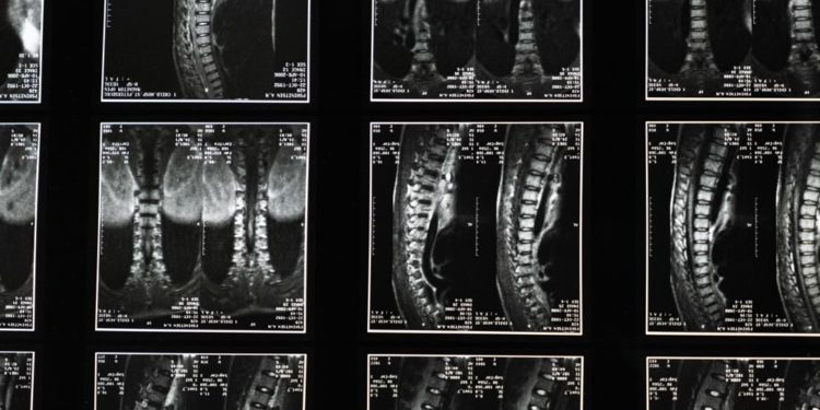 How Do You Apply For Disability Benefits With Scoliosis?